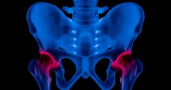 Patellofemoral arthroplasty (PFA) or total knee arthroplasty (TKA ...